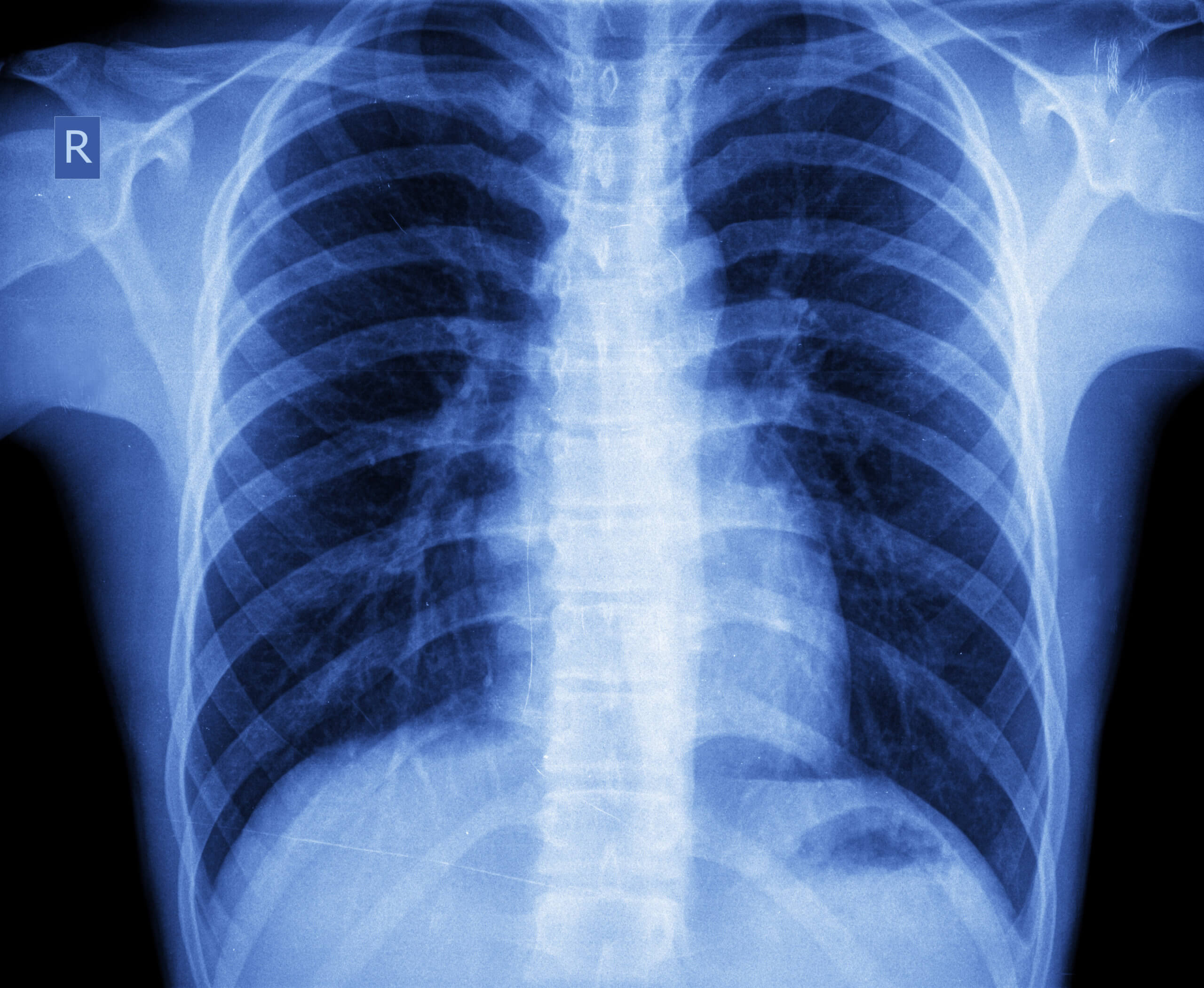 Malignes Pleuramesotheliom - Bessere Überlebensraten durch operativen ...