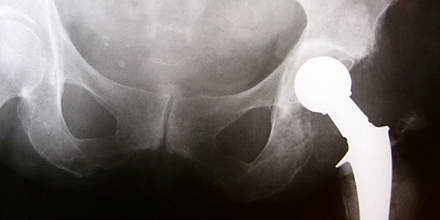 Schenkelhalsbruch vom Blutdrucksenken