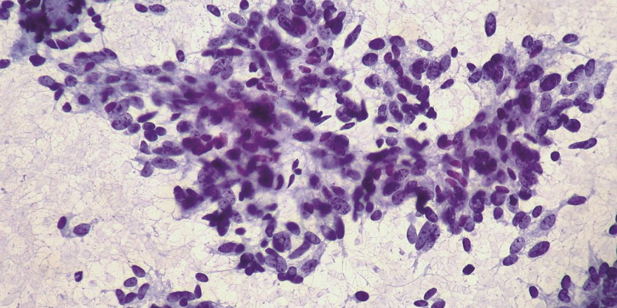 Neuroendokrine Tumoren in der Lunge: heterogen und gar nicht mal so selten