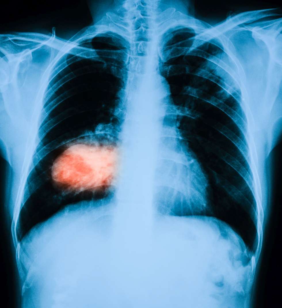 Highlights zum nicht-kleinzelligen Lungenkarzinom (NSCLC)