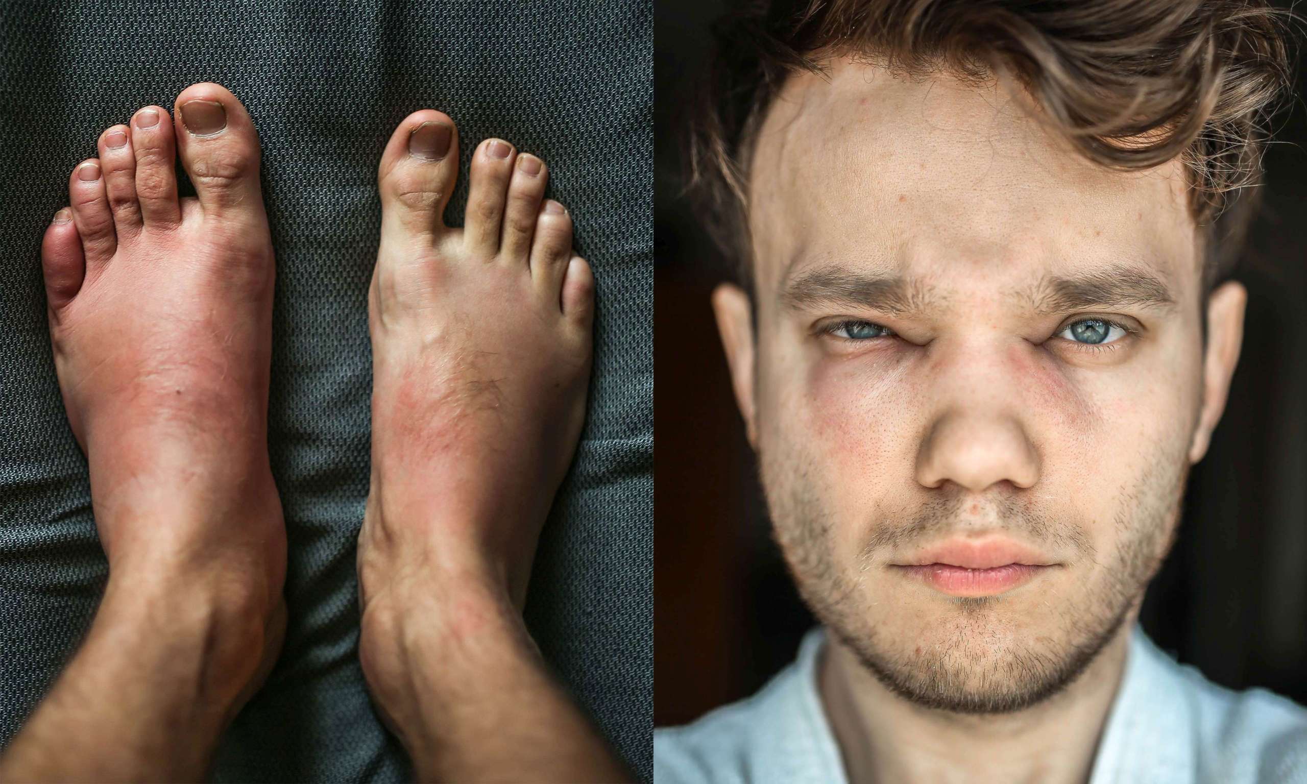 Neue Therapieoptionen beim Angioödem