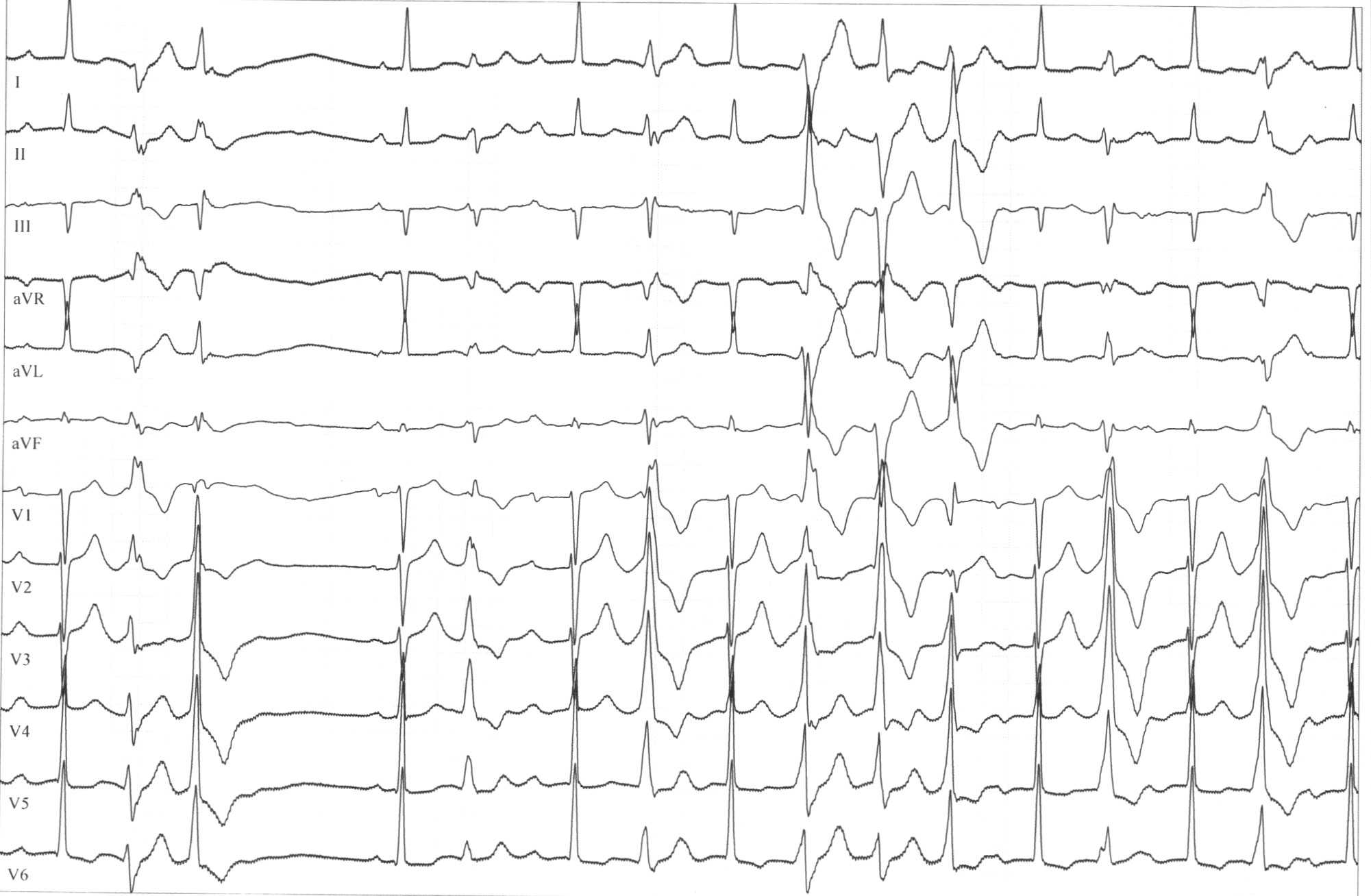 Long-QT-Syndrom: „Mein Herz macht Extraschläge“
