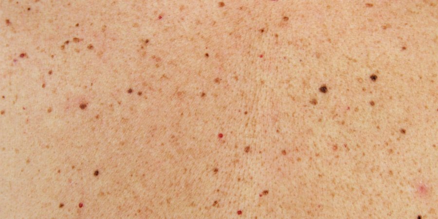 Dermatologie und Venerologie Archive - Medical Tribune Schweiz