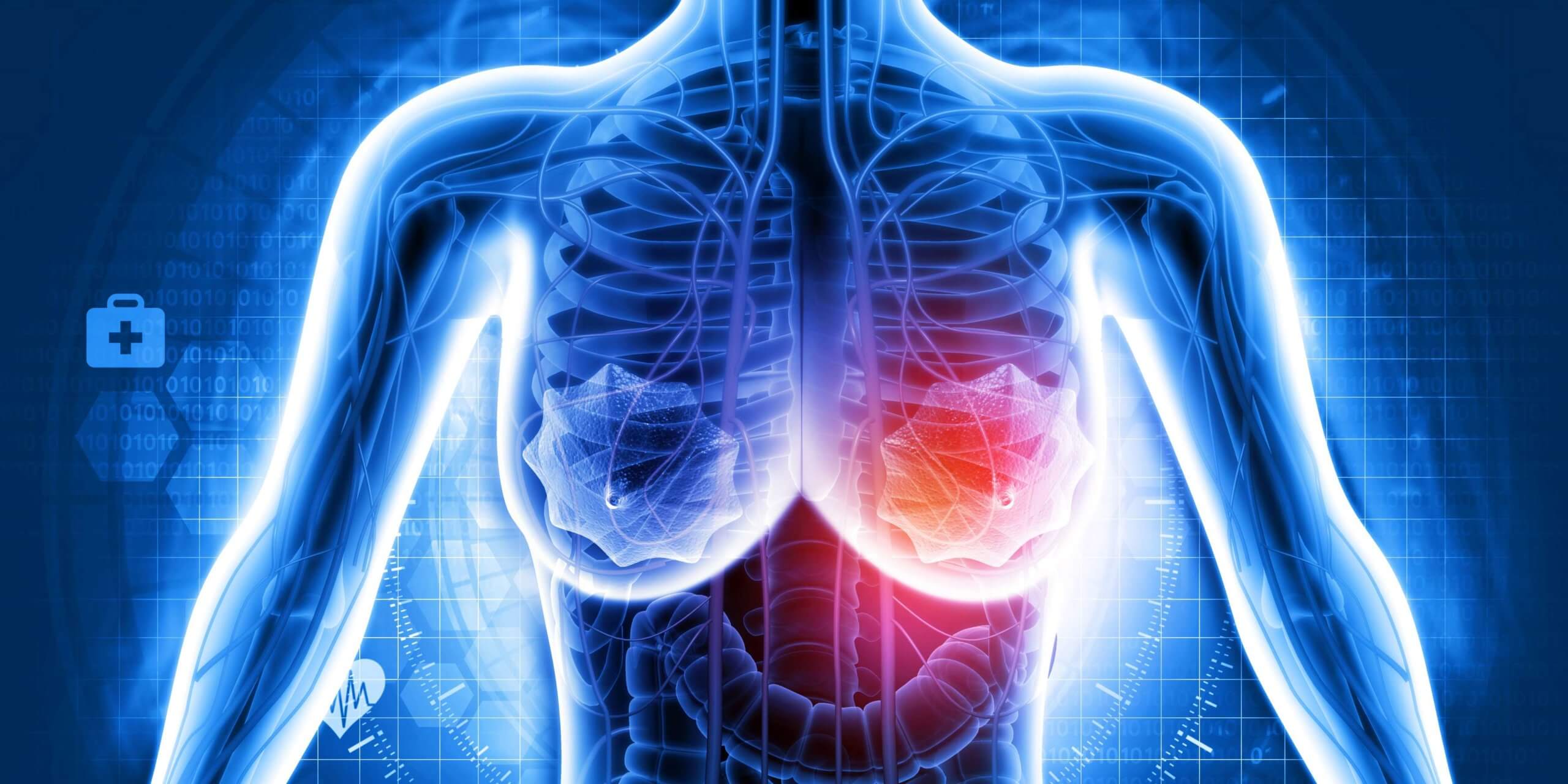 Molekulare Muster beim Mammakarzinom