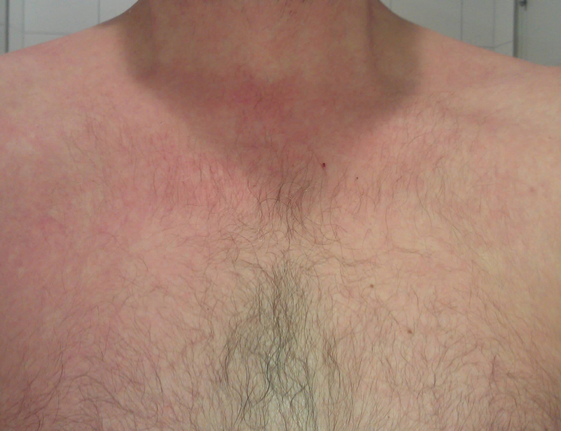 Wie sich das DRESS-Syndrom zu erkennen gibt