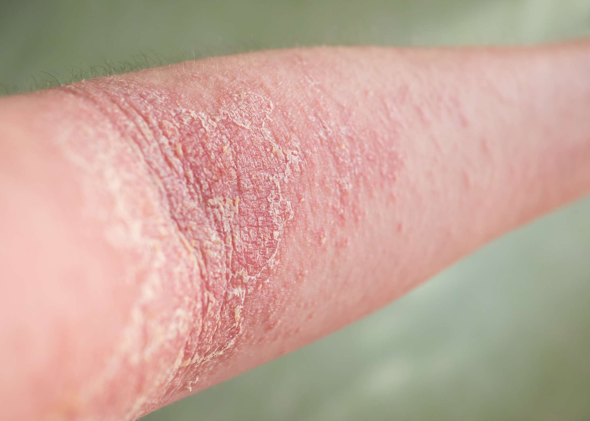 Atopische Dermatitis: IL-22, ein neues interessantes Target