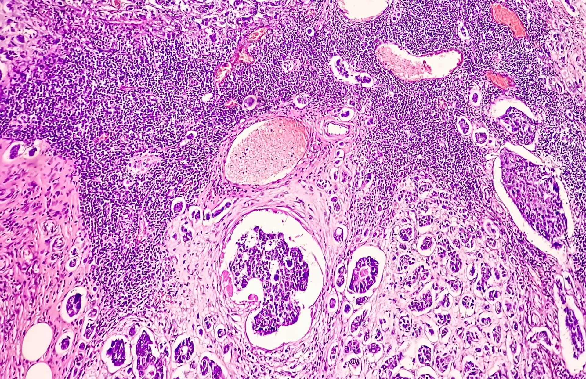 Immunsystem eines «kalten» Tumors - Medical Tribune Schweiz