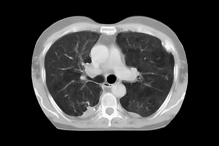 Emphysem: Einteilung in sechs Subtypen