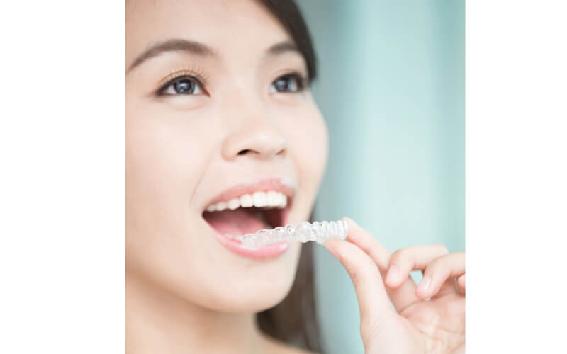 DAS TWIN-ALIGNER®-SYSTEM - Zahnzeitung Schweiz