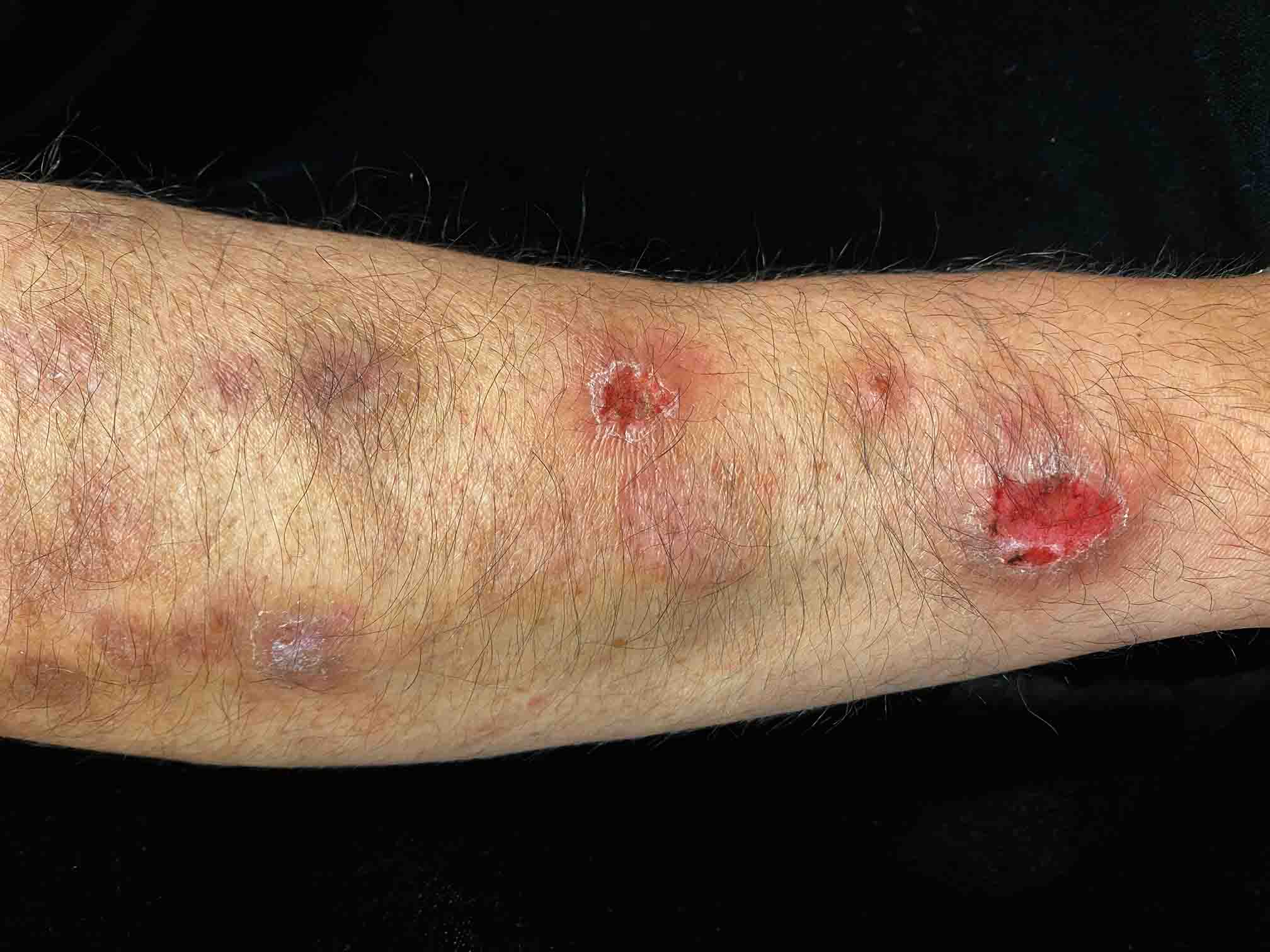 Skin-Picking, Dermatitis artefacta, Borderline: Selbstverletzungen erkennen