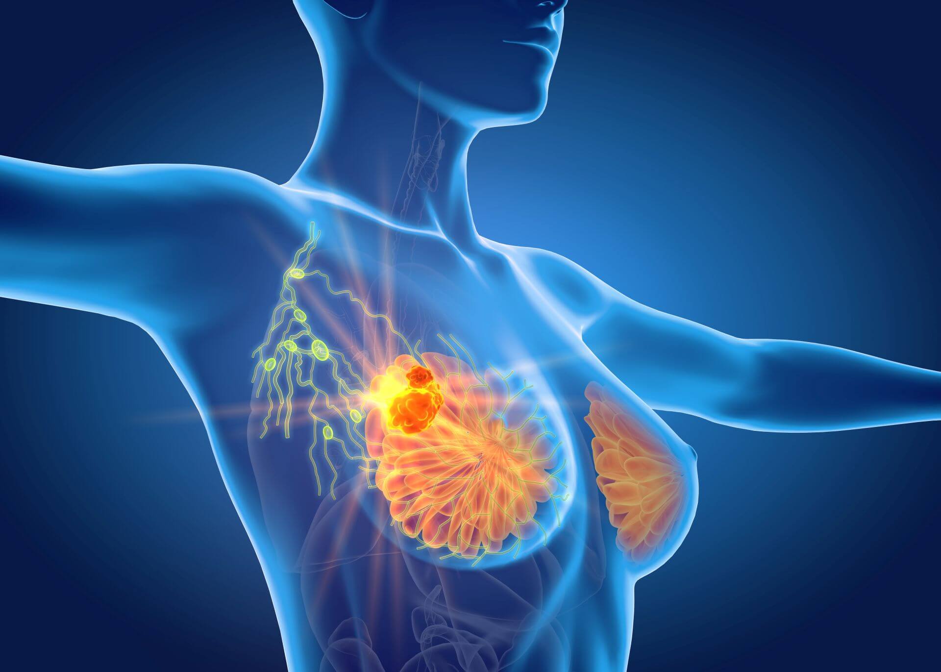 Kein höheres Rezidivrisiko ohne komplette Axilladissektion