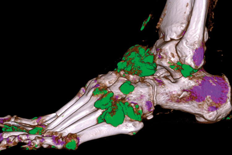 L’imagerie pour la mise en évidence des cristaux de l’arthropathie ...