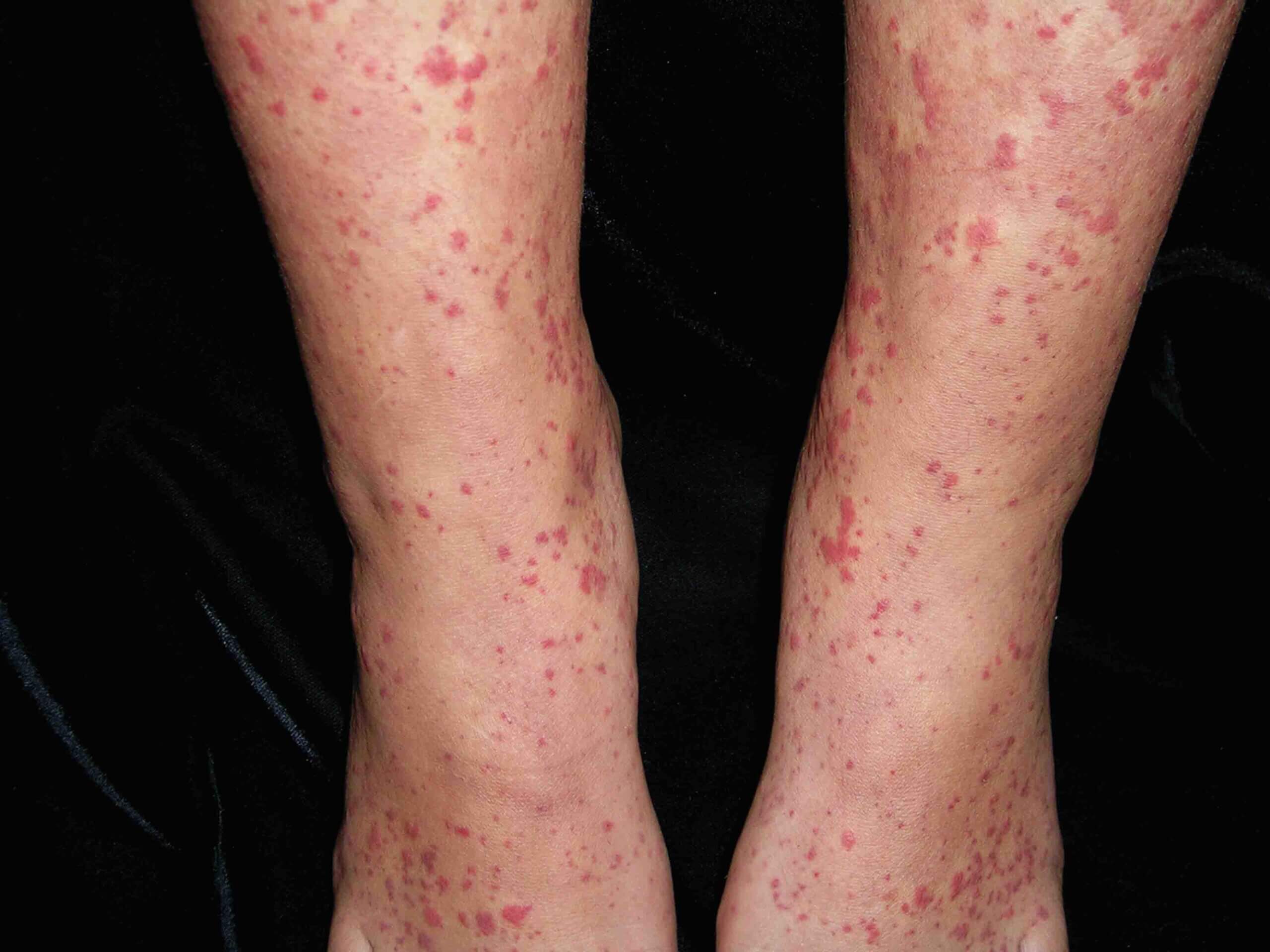 IgA-Vaskulitis im Erwachsenenalter: Vielfältige Symptome und ...