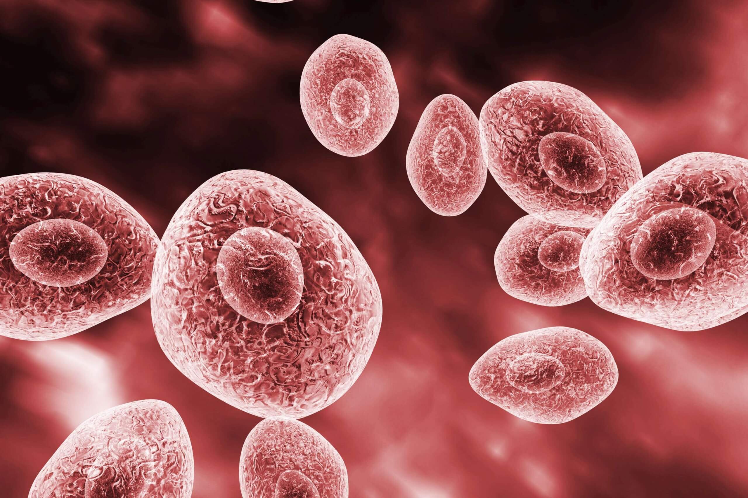 Pneumocystis-Pneumonie: Immunsuppression als Haupttreiber