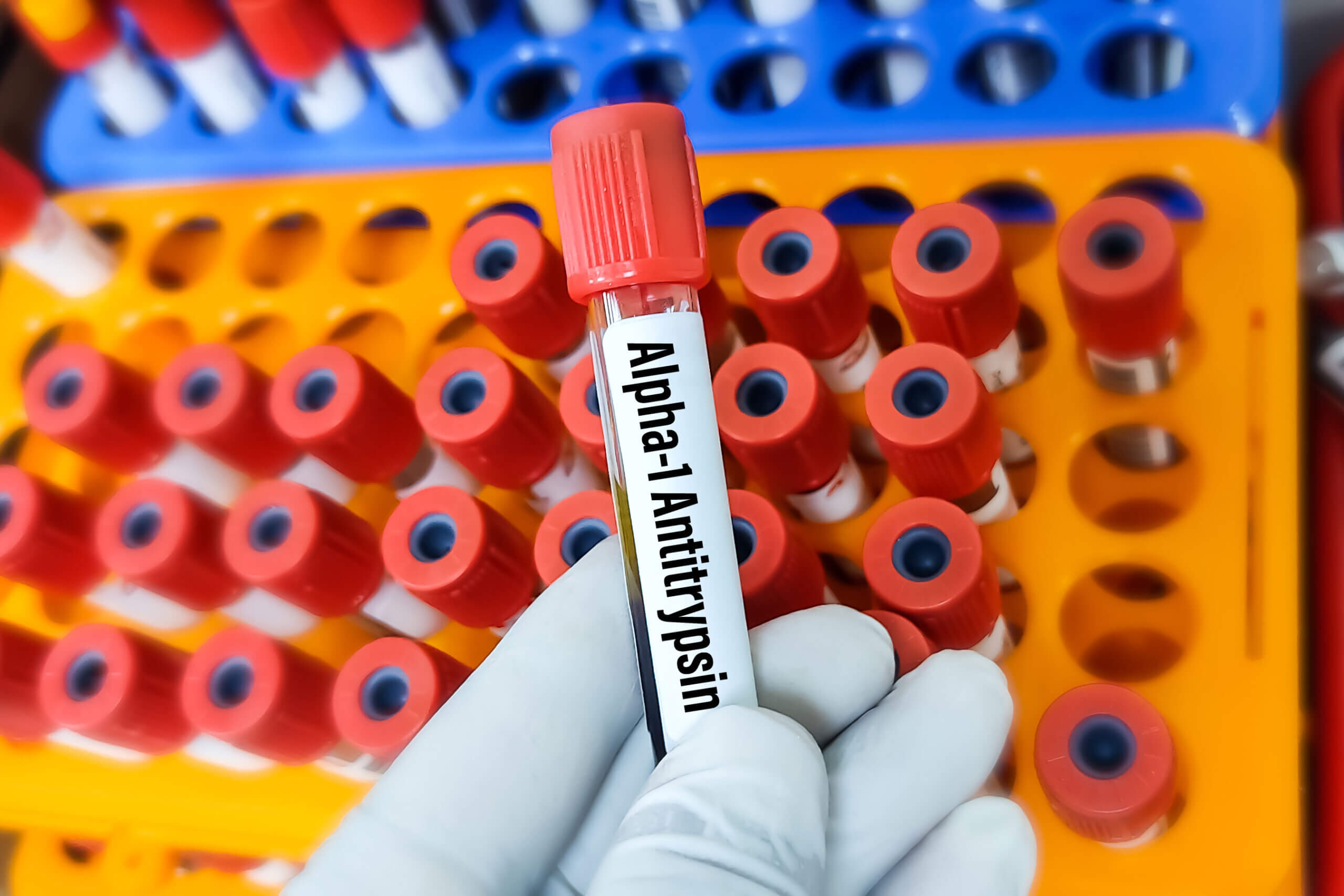 Hilfe bei Alpha-1-Antitrypsin-Mangel