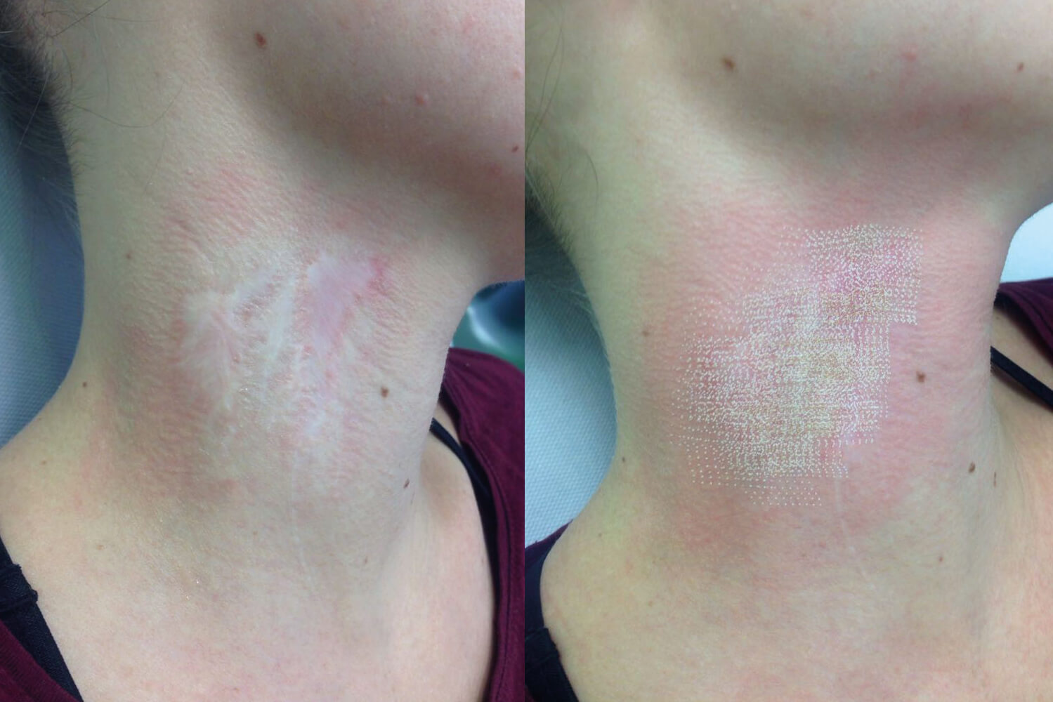 Konservative Therapie von Narben