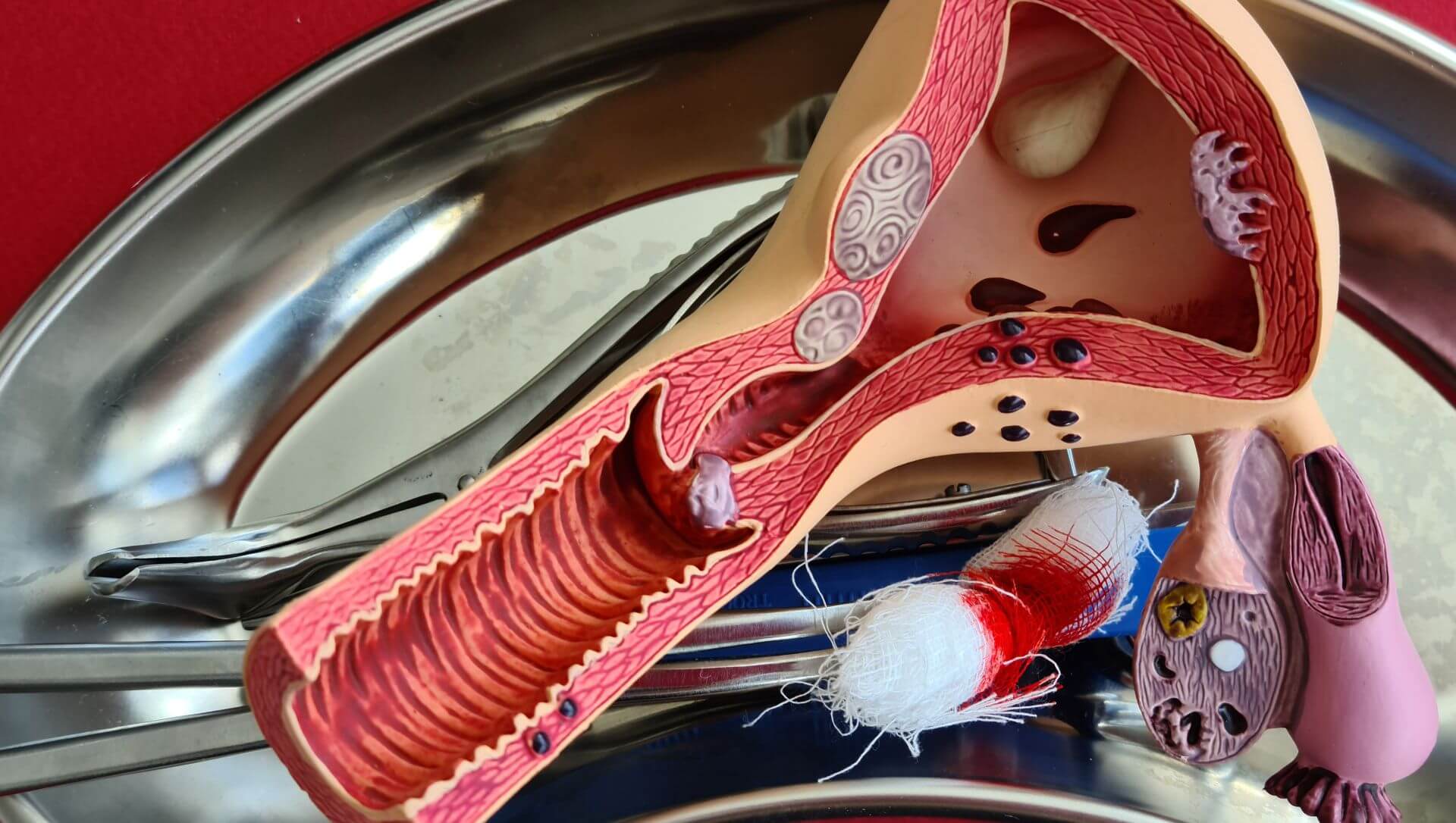 Laparoskopie der offenen Hysterektomie unterlegen