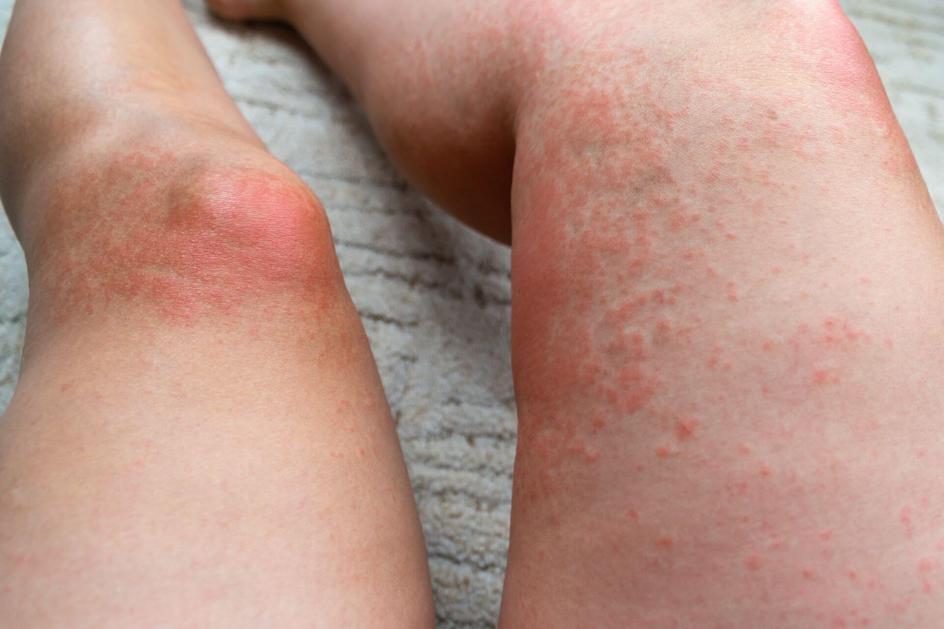 Photodermatoses : Reconnaître et traiter, mais aussi prévenir