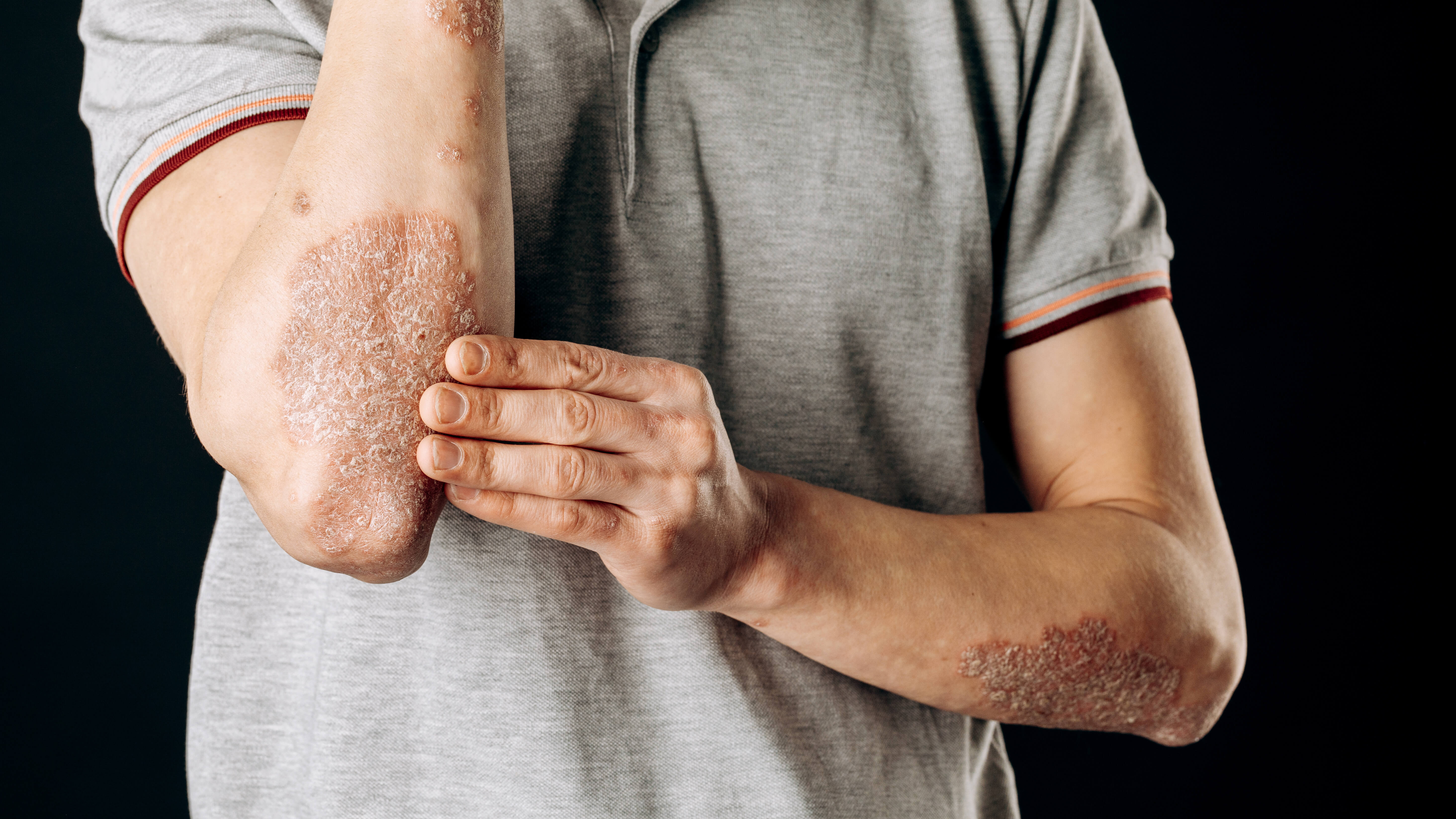 C3 und Calprotectin als Biomarker für frühe Psoriasis-Arthritis