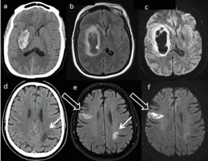 Zerebrale Bildgebung: CT vs. MRT - medonline