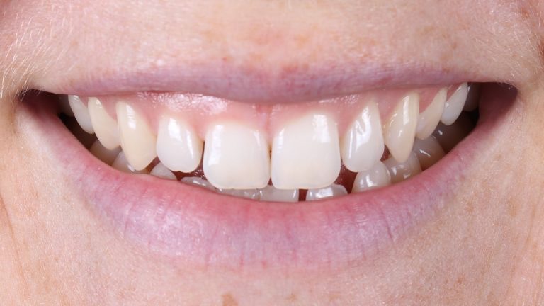 Rauch-bedingter Zahnausfall