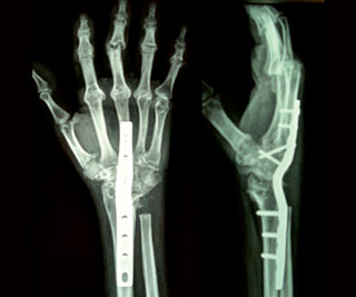 Rheuma-Chirurgie bleibt aktuell